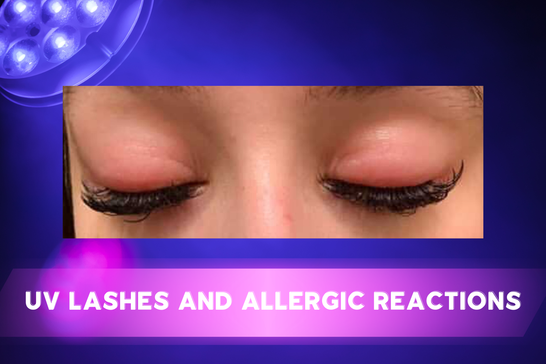 Understanding UV Adhesives: Allergic Reactions vs. Irritations in Lash ...